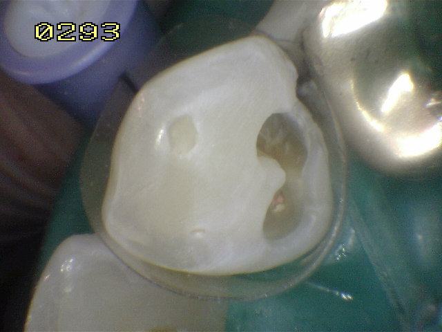 Grabado ácido del esmalte dental