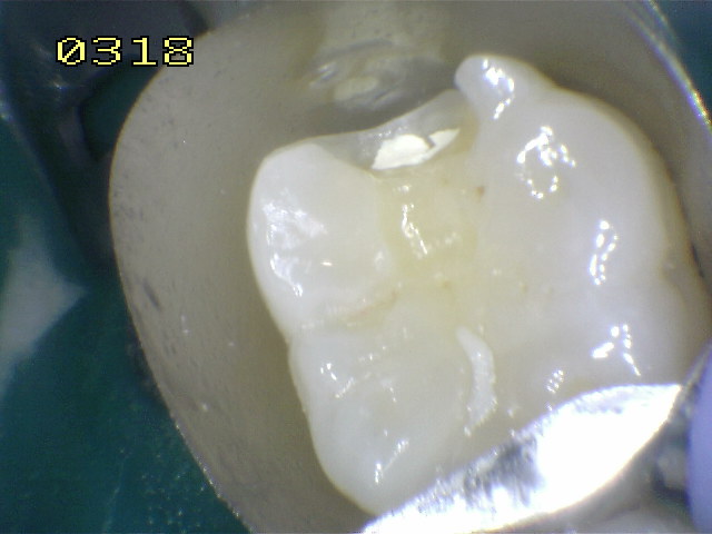 Grabado ácido del esmalte dental